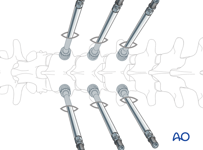 Percutaneous posterior approach for pedicle screw placement