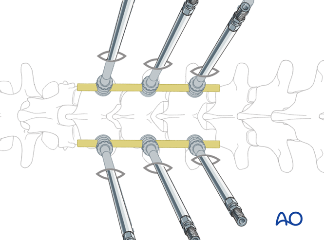 Percutaneous posterior approach for pedicle screw placement
