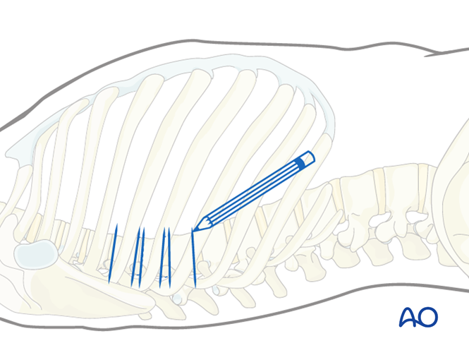 Minimally invasive right sided thoracic approach (T4-T10)