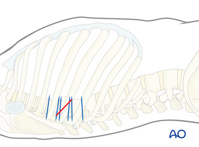 Minimally invasive right sided thoracic approach (T4-T10)