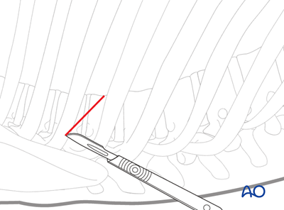 Minimally invasive right sided thoracic approach (T4-T10)