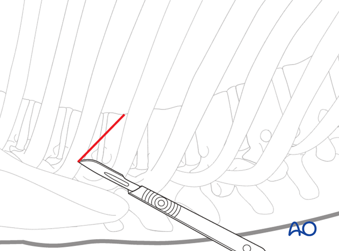Minimally invasive right sided thoracic approach (T4-T10)
