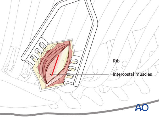 Minimally invasive right sided thoracic approach (T4-T10)