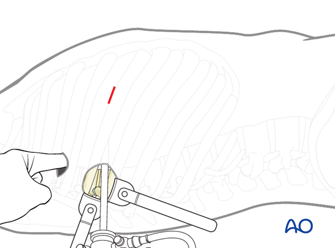 Minimally invasive right sided thoracic approach (T4-T10)