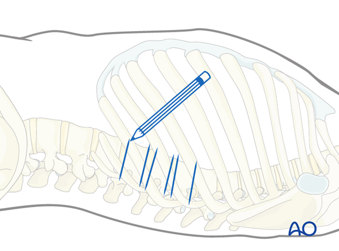 Minimally invasive left sided thoracic approach (T10-L2)