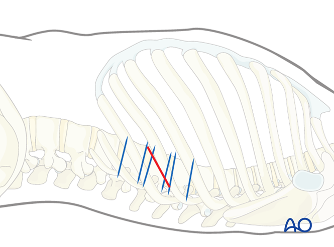 Minimally invasive left sided thoracic approach (T10-L2)