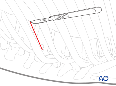 Minimally invasive left sided thoracic approach (T10-L2)