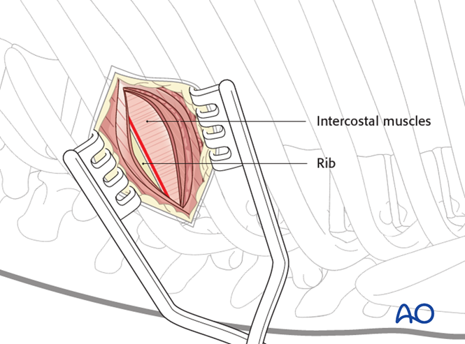 Minimally invasive left sided thoracic approach (T10-L2)