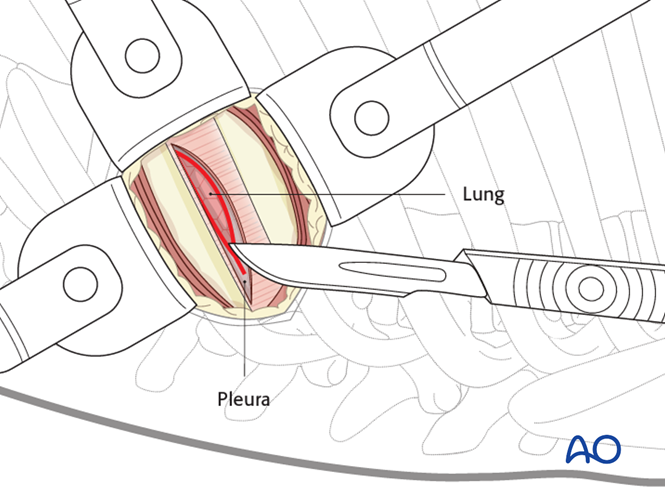 Minimally invasive left sided thoracic approach (T10-L2)