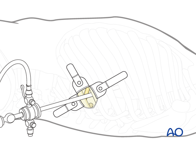 Minimally invasive left sided thoracic approach (T10-L2)