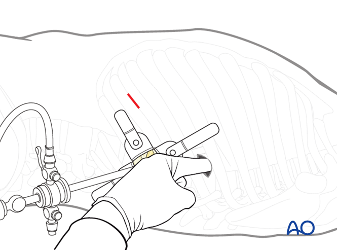 Minimally invasive left sided thoracic approach (T10-L2)