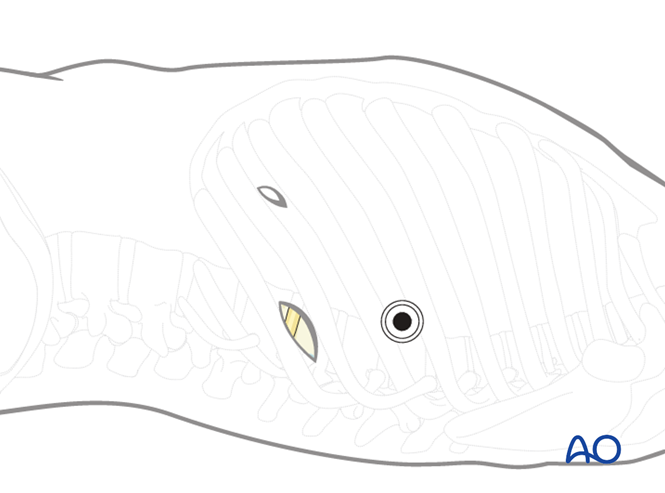 Minimally invasive left sided thoracic approach (T10-L2)