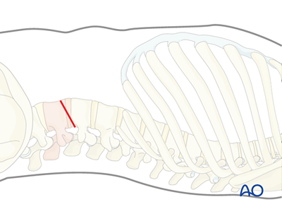 Minimally invasive lumbotomy (L2-L4)