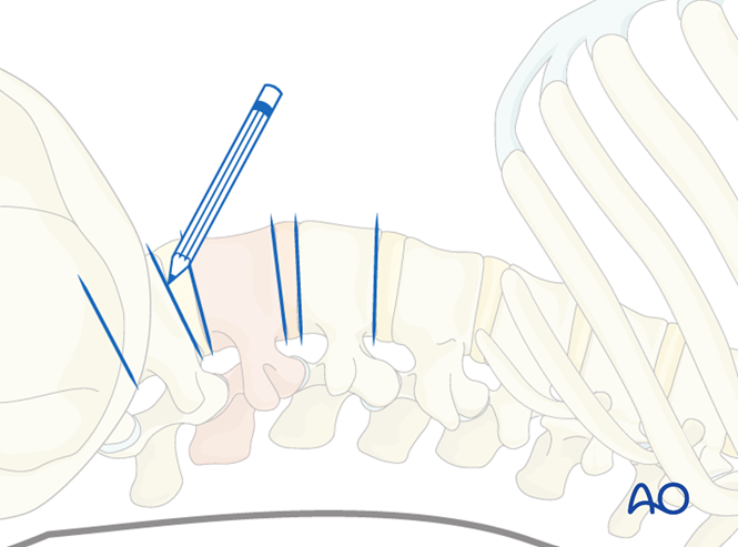 Minimally invasive lumbotomy (L2-L4)