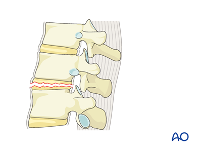 AO Spine thoracolumbar injury classification system