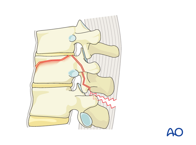AO Spine thoracolumbar injury classification system