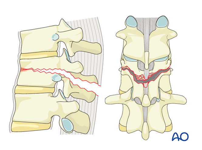 AO Spine thoracolumbar injury classification system