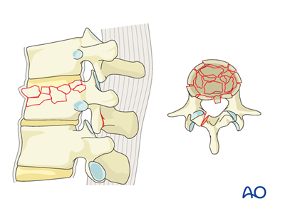 AO Spine thoracolumbar injury classification system
