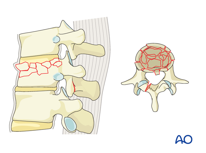 AO Spine thoracolumbar injury classification system