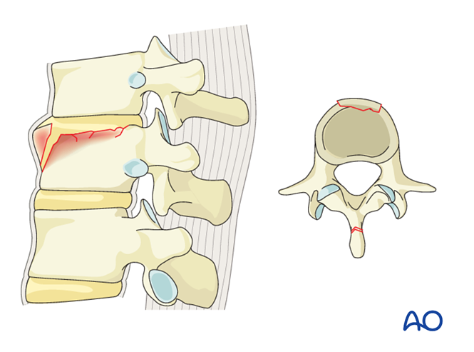 A1 Wedge-compression fractures