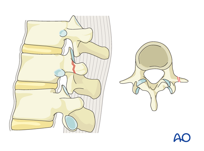 AO Spine thoracolumbar injury classification system