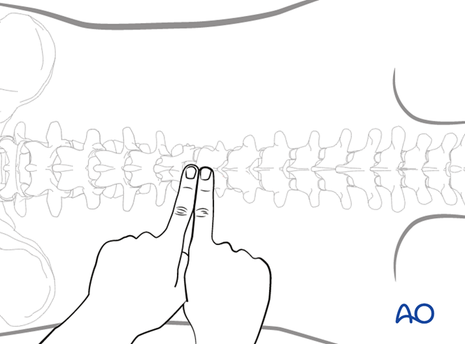 A1 Wedge-compression fractures