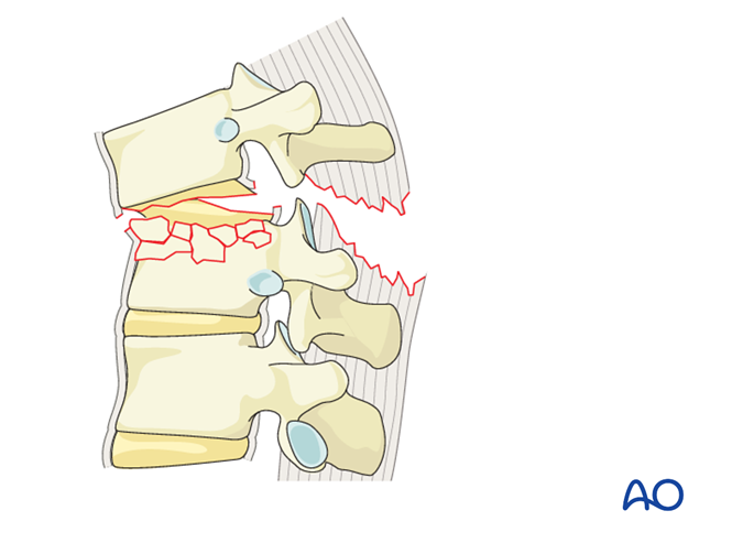 AO Spine thoracolumbar injury classification system