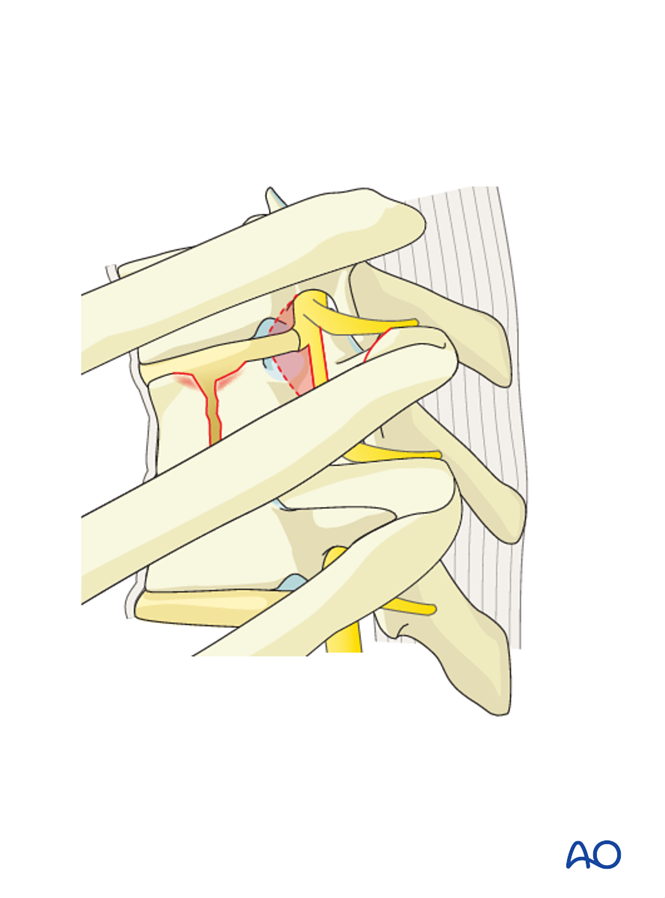 MIS Anterior stabilization for A2 - Split fractures