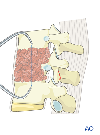 Anterior stabilization for A3 Incomplete burst fractures