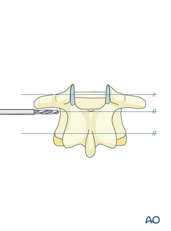 Anterior stabilization for A3 Incomplete burst fractures