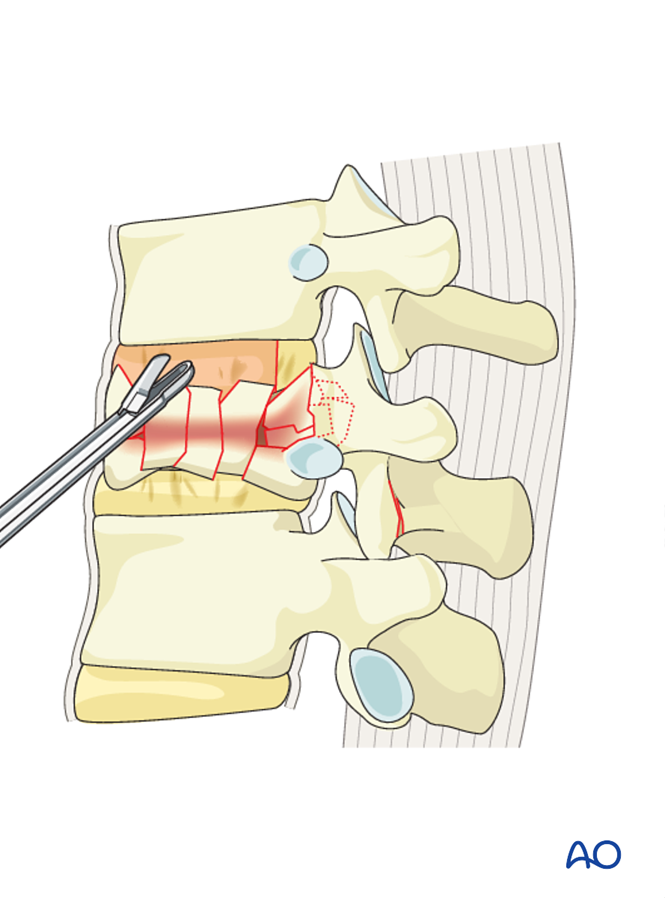 MIS Anterior Stabilization for A4 Complete burst fractures