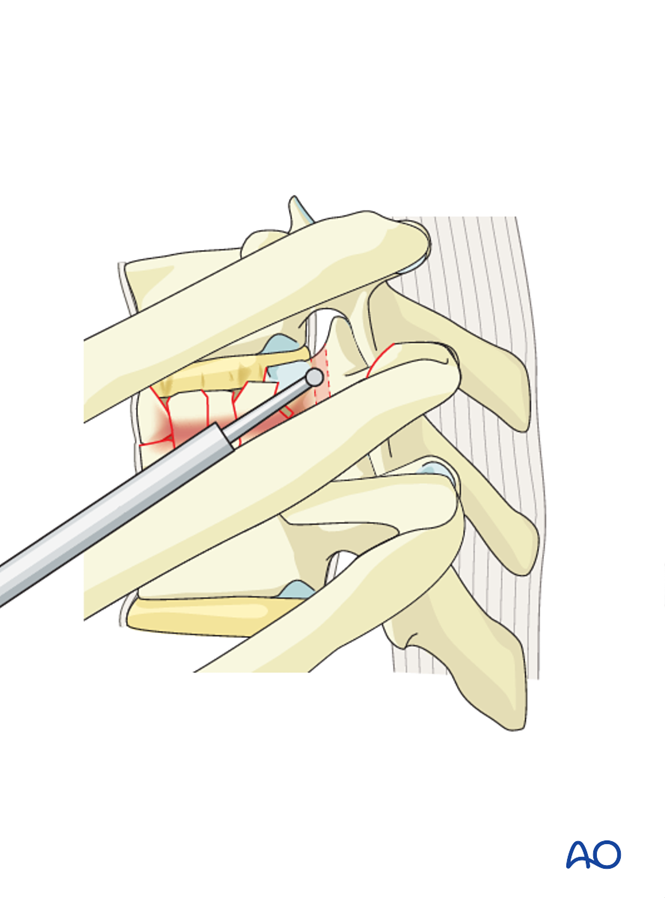 MIS Anterior Stabilization for A4 Complete burst fractures