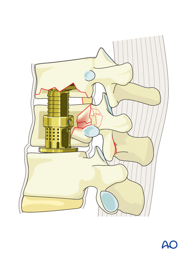 MIS Anterior Stabilization for A4 Complete burst fractures