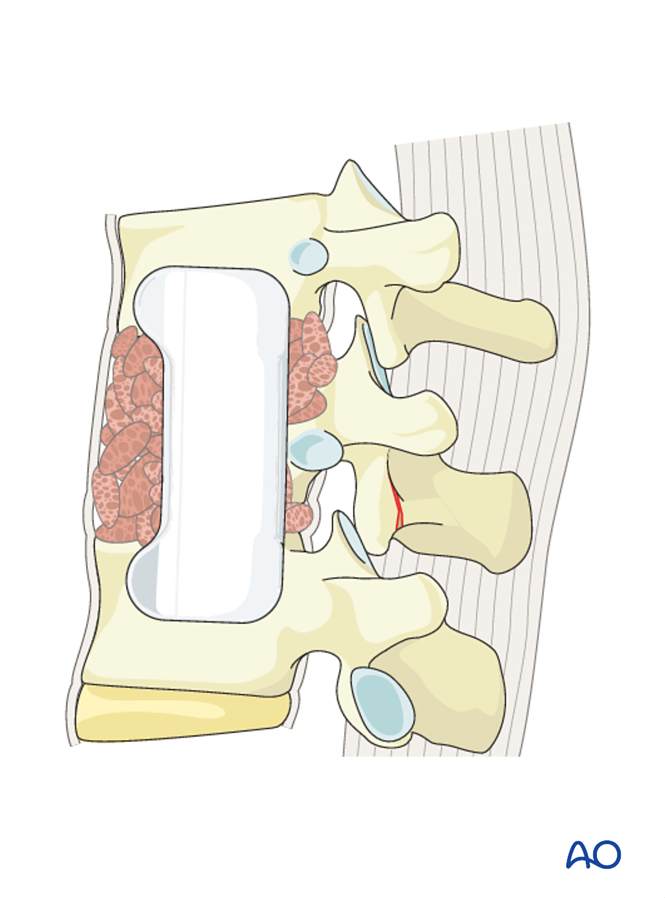 MIS Anterior Stabilization for A4 Complete burst fractures