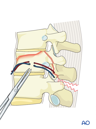 Anterior stabilization for B2 Posterior tension band disruption