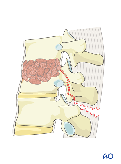 Anterior stabilization for B2 Posterior tension band disruption