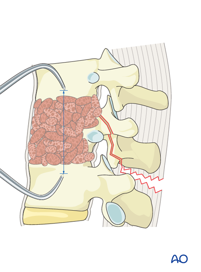 Anterior stabilization for B2 Posterior tension band disruption