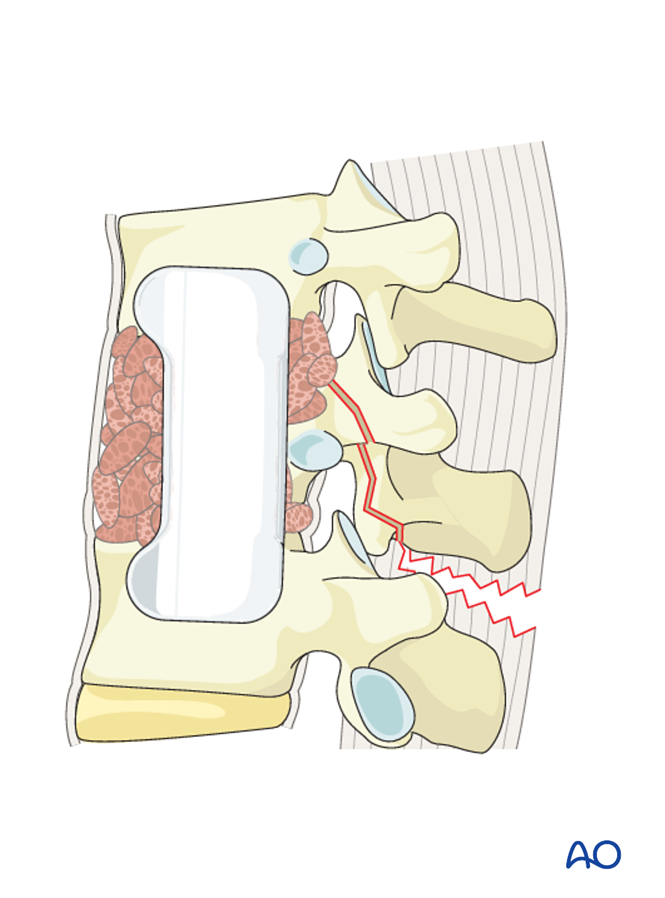 Anterior stabilization for B2 Posterior tension band disruption