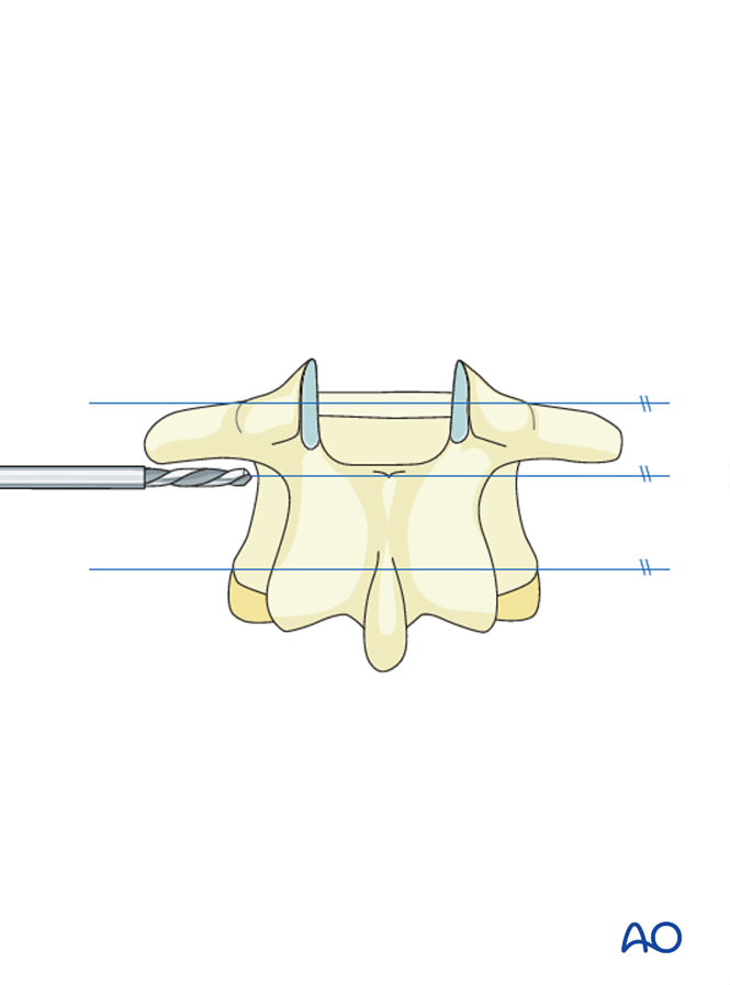 Anterior stabilization for B2 Posterior tension band disruption