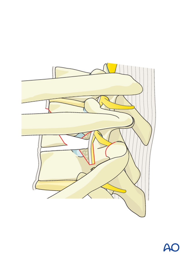 Anterior stabilization for B3 Hyperextension