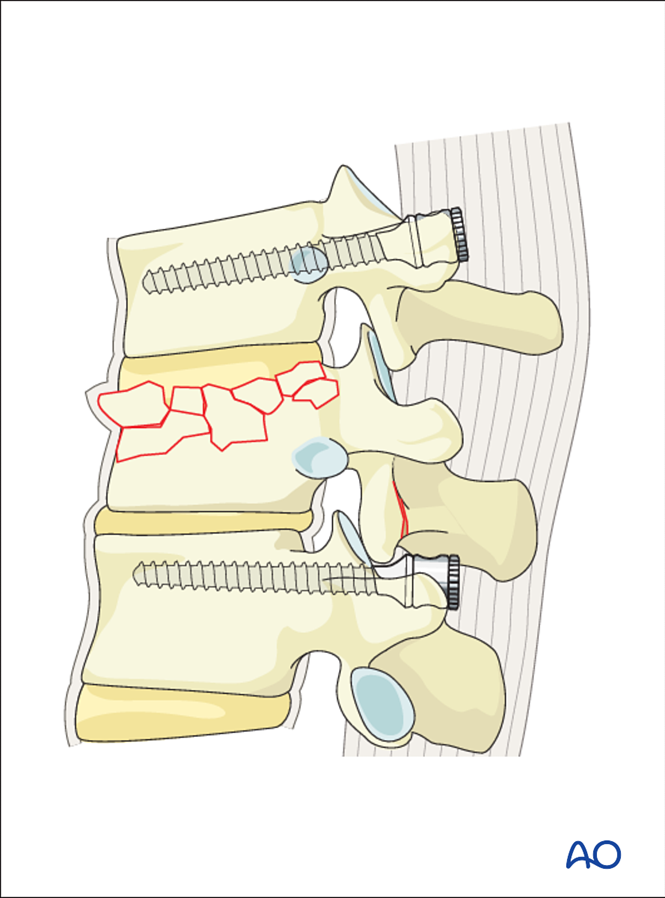 Posterior short segment fixation with pedicle screws for A3 Incomplete ...