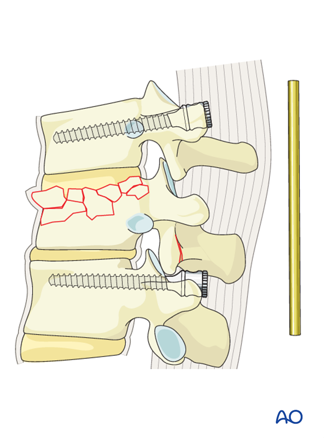 Posterior short segment fixation with pedicle screws for A3 Incomplete ...