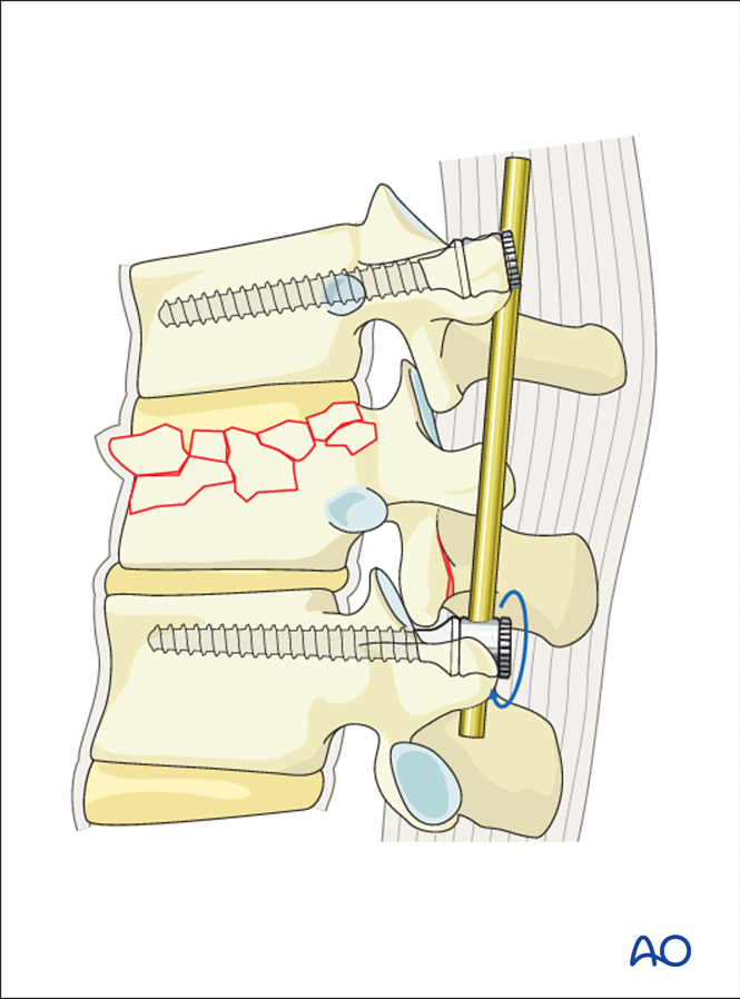 Posterior short segment fixation with pedicle screws for A3 Incomplete ...