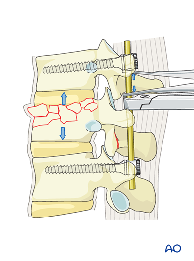 Posterior short segment fixation with pedicle screws for A3 Incomplete ...