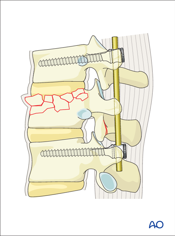 Posterior short segment fixation with pedicle screws for A3 Incomplete ...