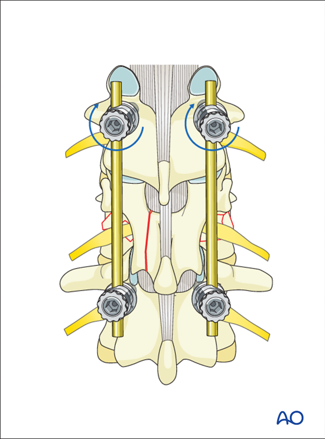 Posterior short segment fixation with pedicle screws for A4 Complete ...