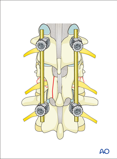 Posterior short segment fixation with pedicle screws for A4 Complete ...