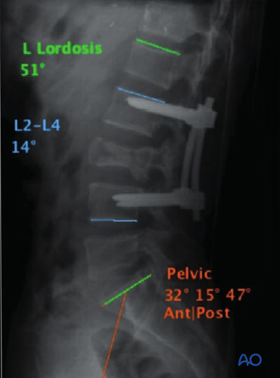 MIS posterior short segment fixation with pedicle screws for B2 ...