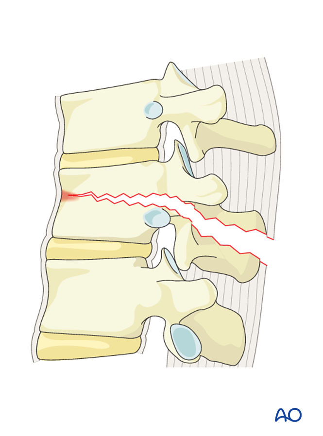 Posterior short segment fixation with pedicle screws for B1 ...