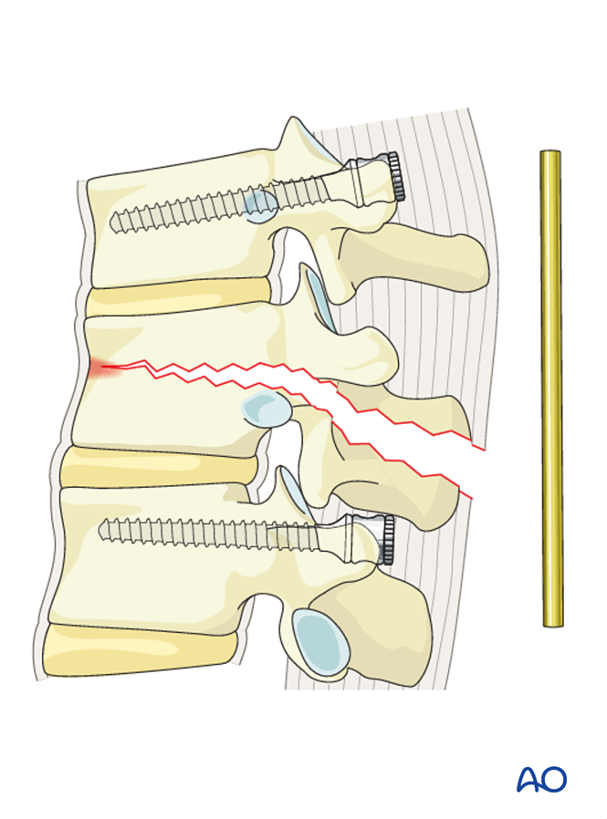 Posterior short segment fixation with pedicle screws for B1 ...